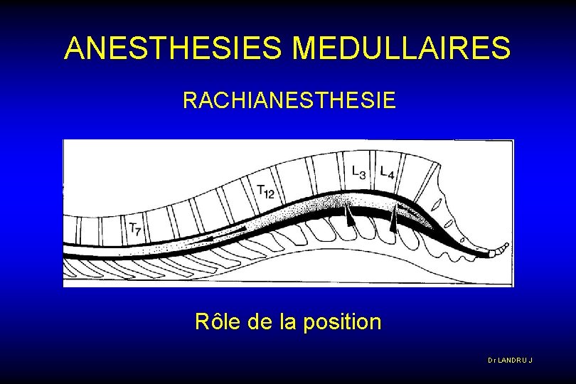 ANESTHESIE LOCOREGIONALE Dr LANDRU J Anesthsie slective dune