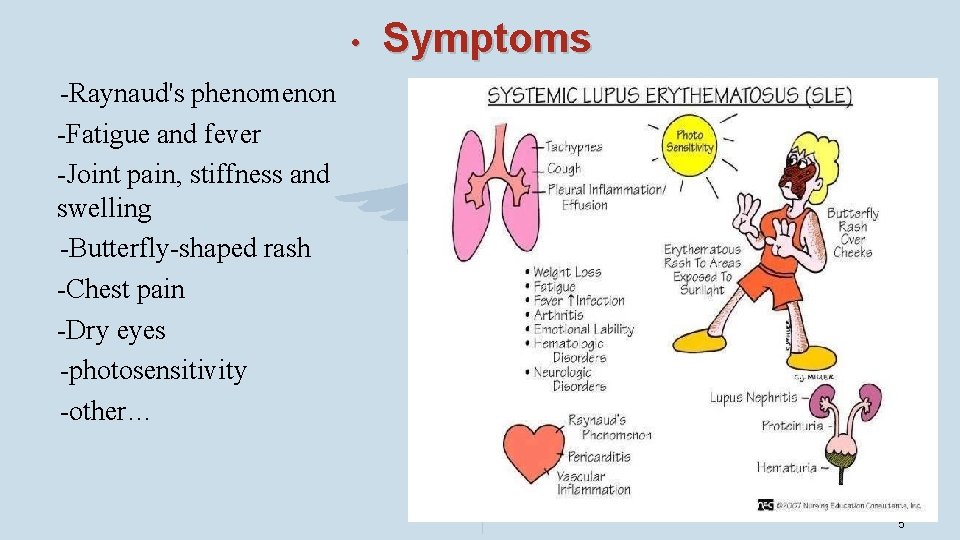 Systemic Lupus Erythematosus SLE Sarra Abdurrezag Esharik Defining