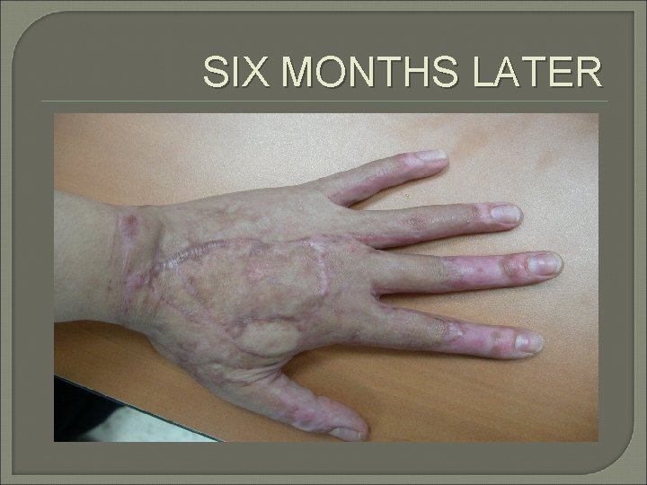 BURNS 30 yo patient transfered to your burn