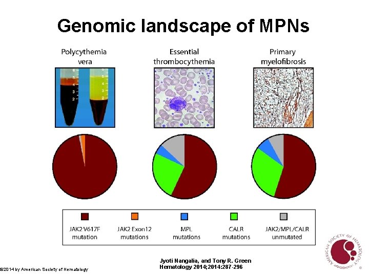 Myelodysplastic Syndrome MDS and Myelofibrosis Syndromes Whats Next