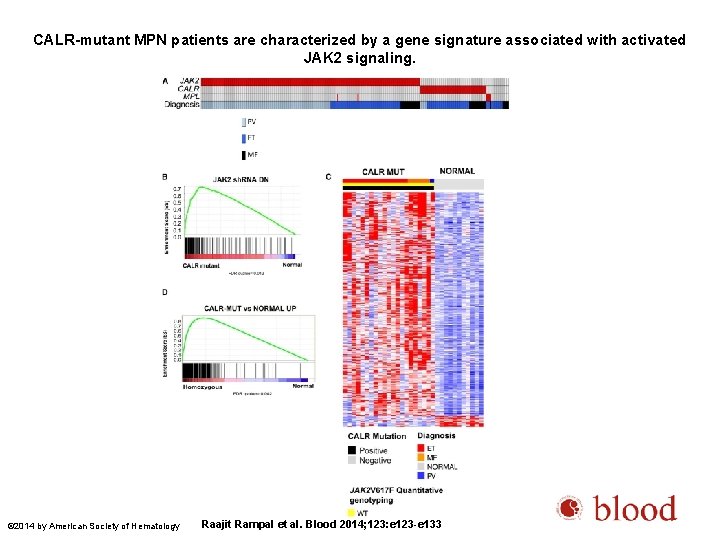 Myelodysplastic Syndrome MDS and Myelofibrosis Syndromes Whats Next