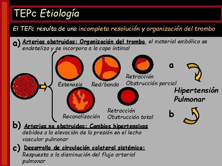 Tromboembolismo pulmonar crnico e hipertensin pulmonar Revisin de