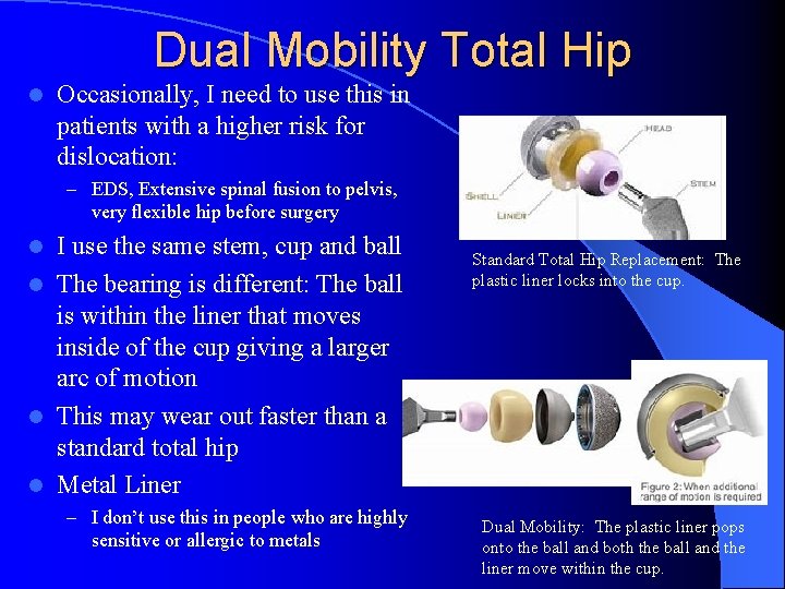Understanding Total Hip Replacement Brian J White MD