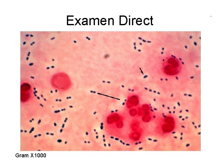 Infections Respiratoires Infections communautaires S Pneumoniae ...