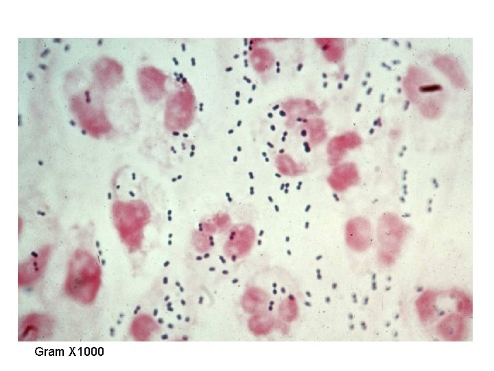 Infections Respiratoires Infections communautaires S Pneumoniae ...