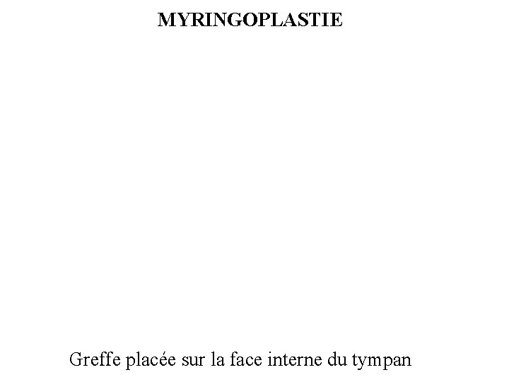 TYPES DINTERVENTIONS 14 Otoplastieet Epithses Myringotomie ou paracentse