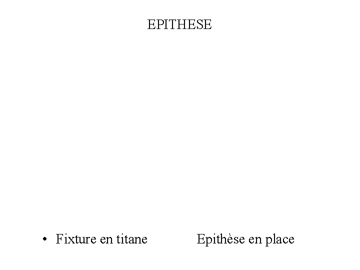 TYPES DINTERVENTIONS 14 Otoplastieet Epithses Myringotomie ou paracentse