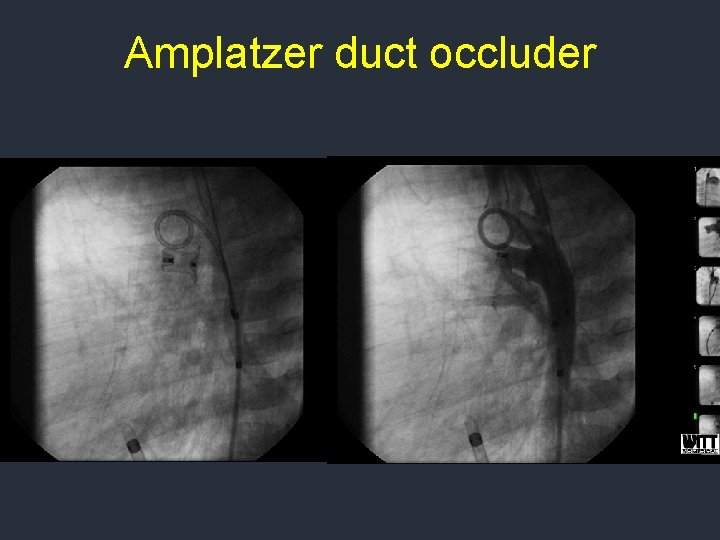 New AGA Devices PDA II Vascular Plug IV