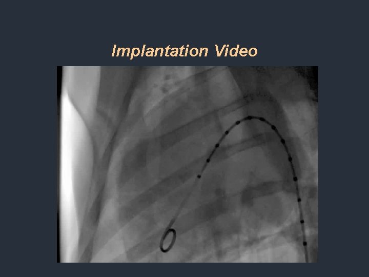 New AGA Devices PDA II Vascular Plug IV