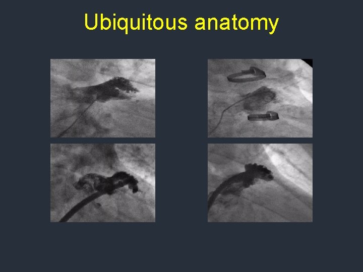 New AGA Devices PDA II Vascular Plug IV