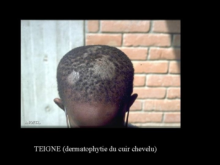 MYCOLOGIE ETUDE DES CHAMPIGNONS PRINCIPAUX CHAMPIGNONS PATHOGENES POUR