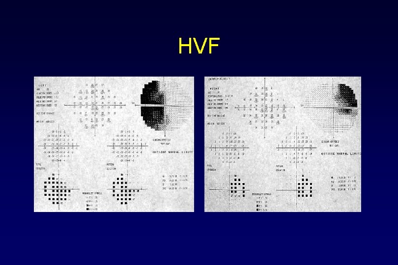 Neuroophthalmology Review First Hour Afferent Visual System Thomas