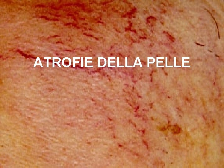 ATROFIE DELLA PELLE Atrofie della pelle In diverse