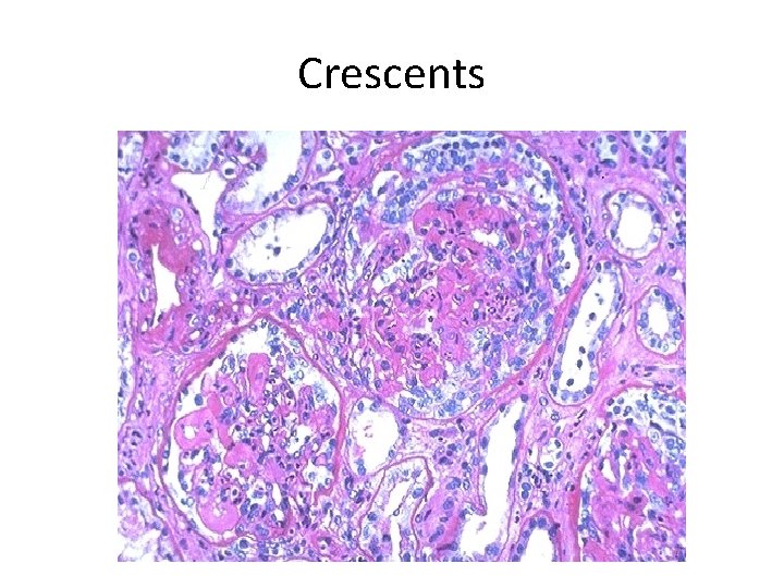 Rapidly Progressive Crescentic GlomerulonephritisRPGN Is a syndrome ...