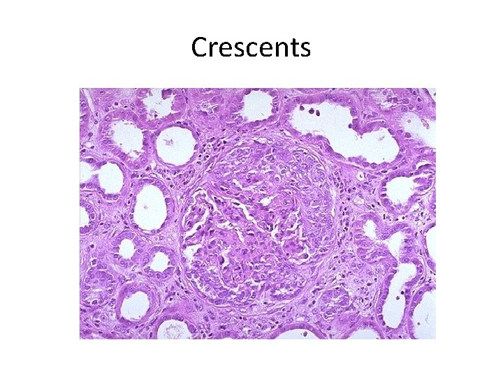 Rapidly Progressive Crescentic GlomerulonephritisRPGN Is a syndrome ...