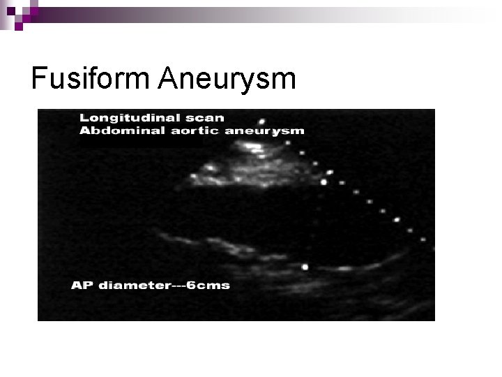 AortaIVC Abdominal Vascular Aorta Size n Portions n