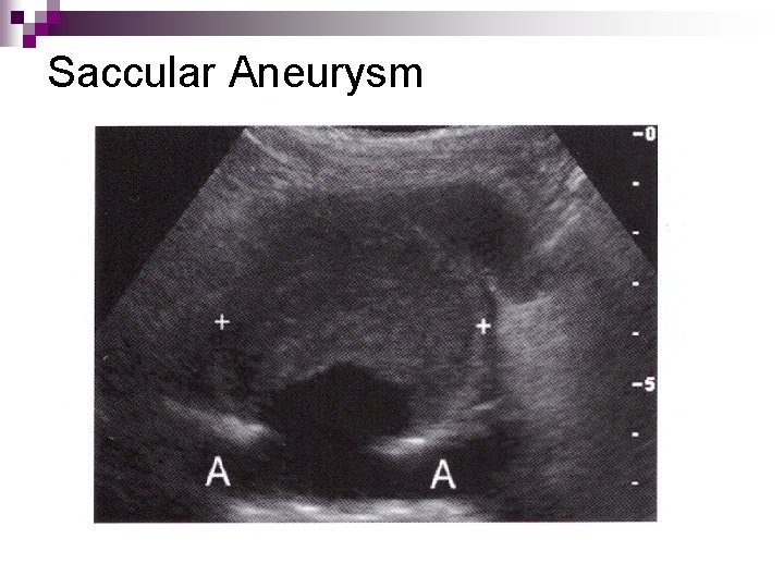 AortaIVC Abdominal Vascular Aorta Size n Portions n