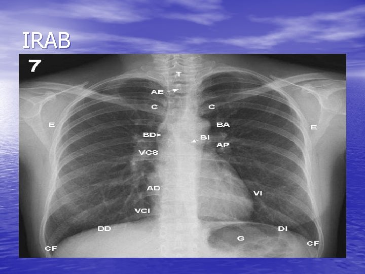 INFECCIN RESPIRATORIA AGUDA BAJA IRAB FACTORES DE RIESGO