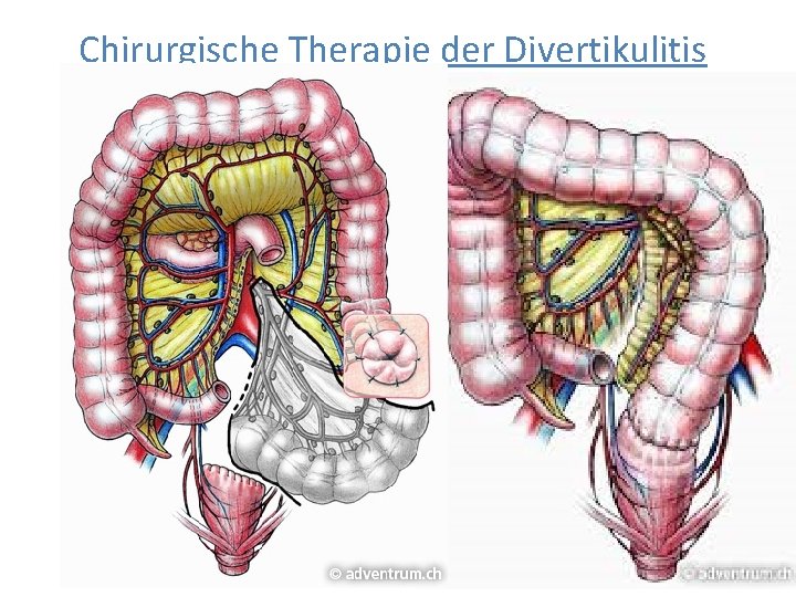 Chirurgische Therapie der Kolondivertikuloseitis PD Dr med Feride