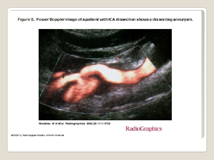 Craniocervical Arterial Dissection Spectrum of Imaging Findings ...