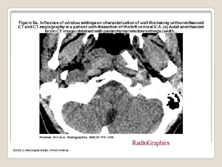 Craniocervical Arterial Dissection Spectrum of Imaging Findings ...