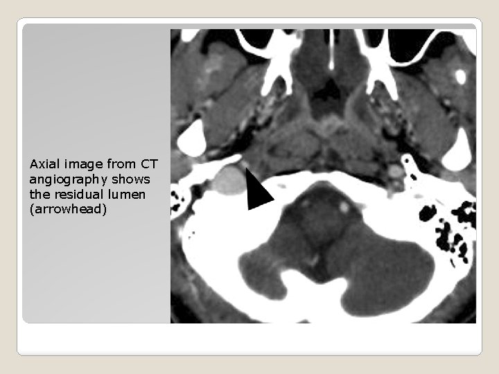 Craniocervical Arterial Dissection Spectrum of Imaging Findings ...