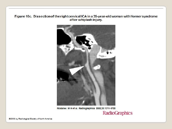 Craniocervical Arterial Dissection Spectrum of Imaging Findings ...