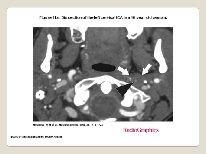 Craniocervical Arterial Dissection Spectrum of Imaging Findings ...