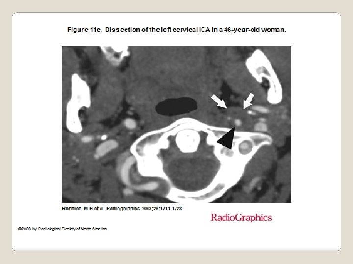 Craniocervical Arterial Dissection Spectrum of Imaging Findings ...
