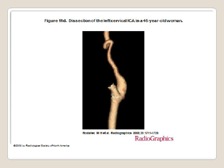 Craniocervical Arterial Dissection Spectrum of Imaging Findings ...