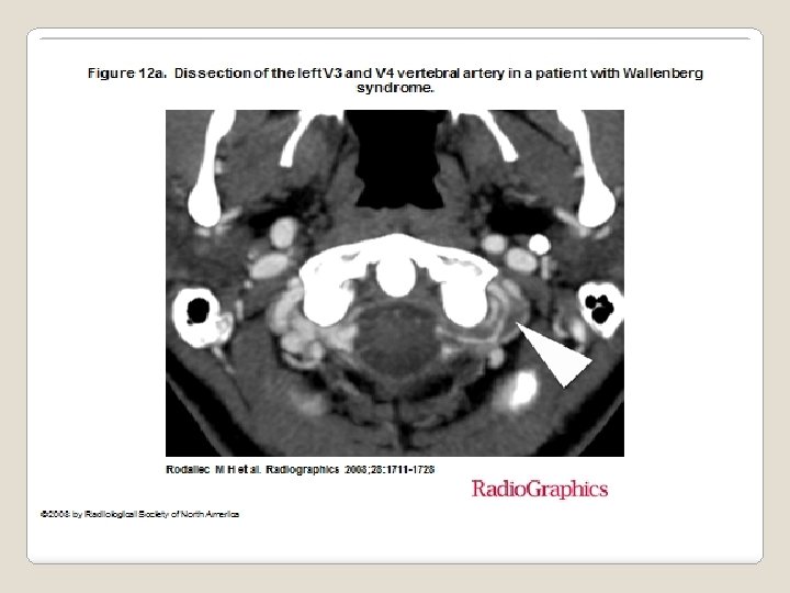 Craniocervical Arterial Dissection Spectrum of Imaging Findings ...