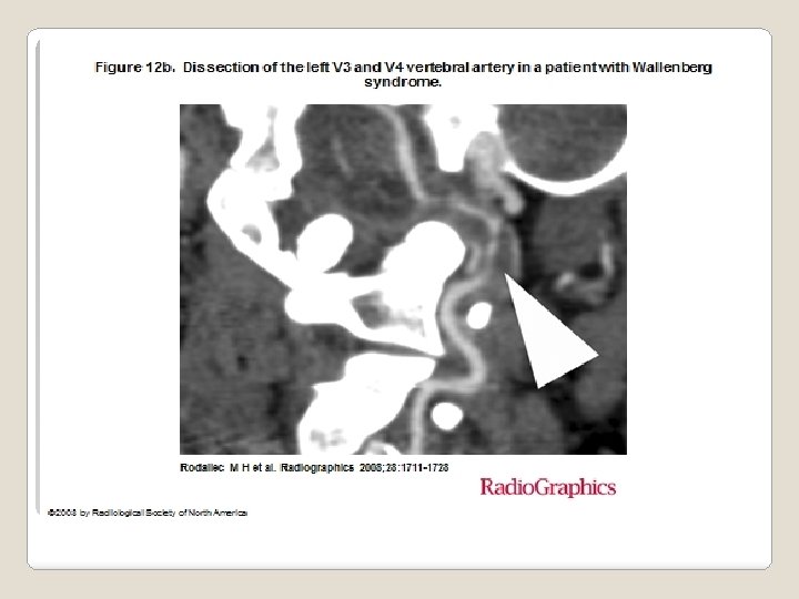 Craniocervical Arterial Dissection Spectrum of Imaging Findings ...