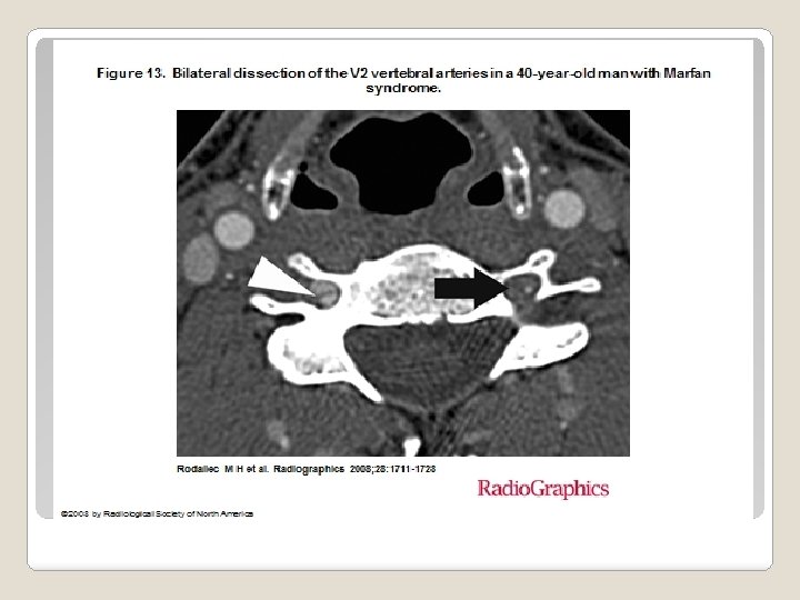 Craniocervical Arterial Dissection Spectrum of Imaging Findings ...