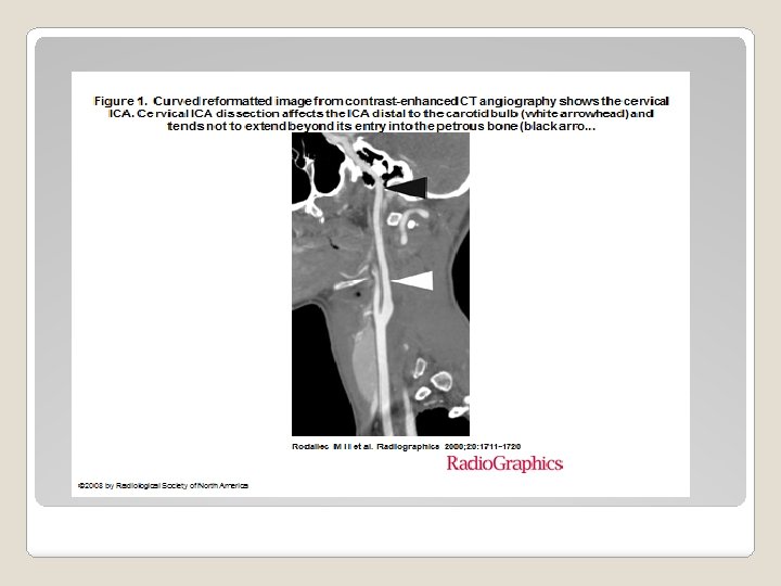 Craniocervical Arterial Dissection Spectrum of Imaging Findings ...