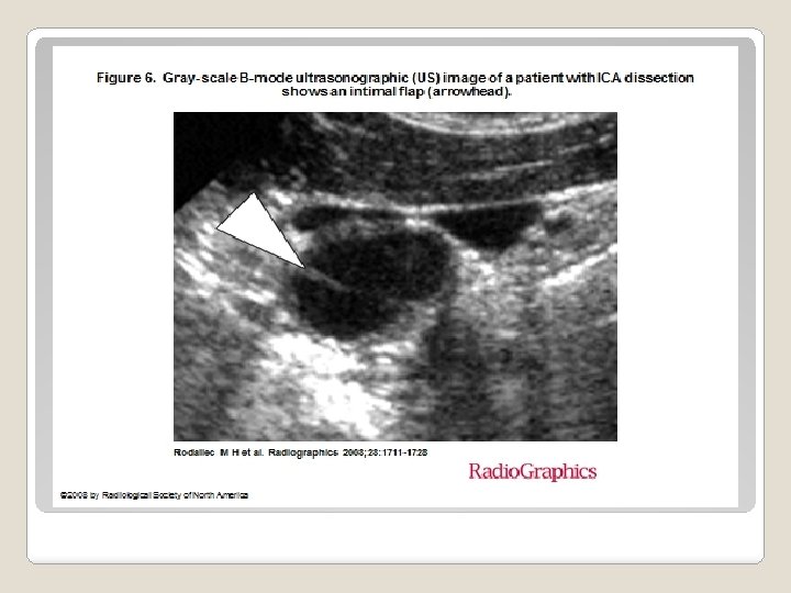 Craniocervical Arterial Dissection Spectrum of Imaging Findings ...