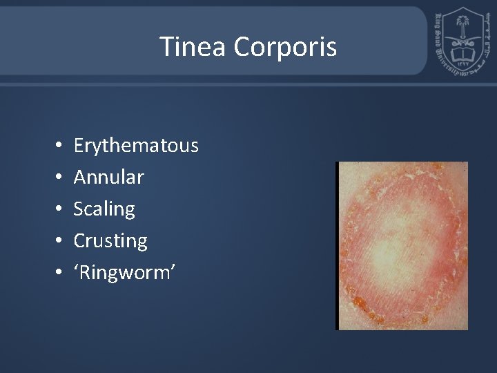 Lecture Title Fungal Infections of the skin Superficial