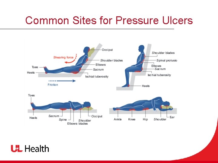 Medical Concerns After Spinal Cord Injury Frazier Rehab