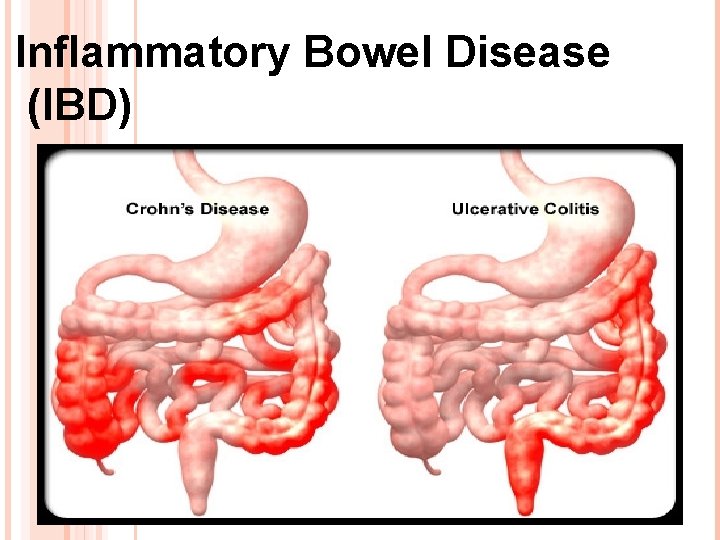 Inflammatory Bowel Disease IBD The main objectives of