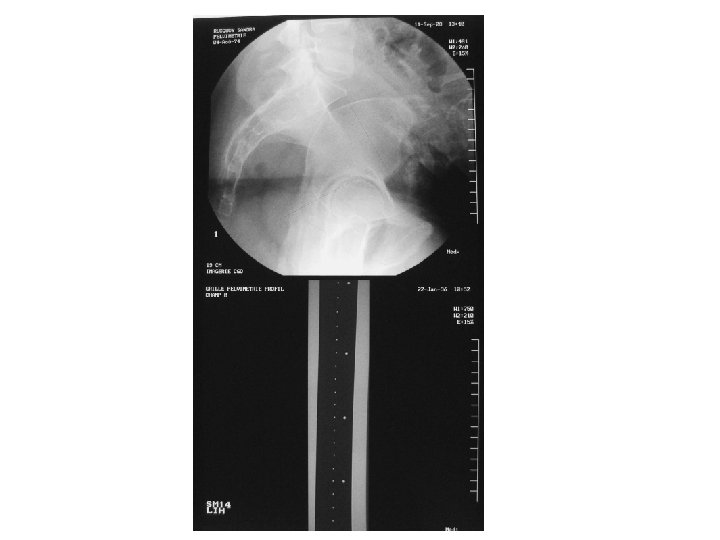 Examens radiologiques en obsttrique pelvimtrie LE BASSIN MATERNEL