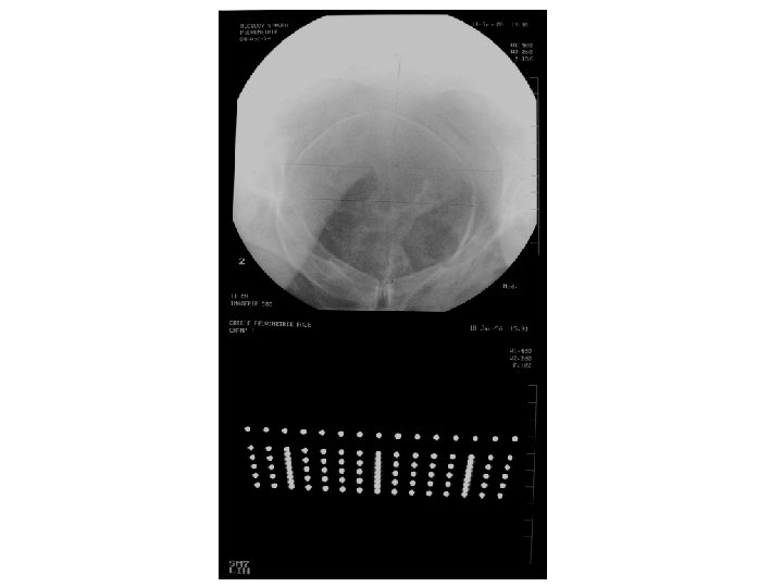 Examens radiologiques en obsttrique pelvimtrie LE BASSIN MATERNEL