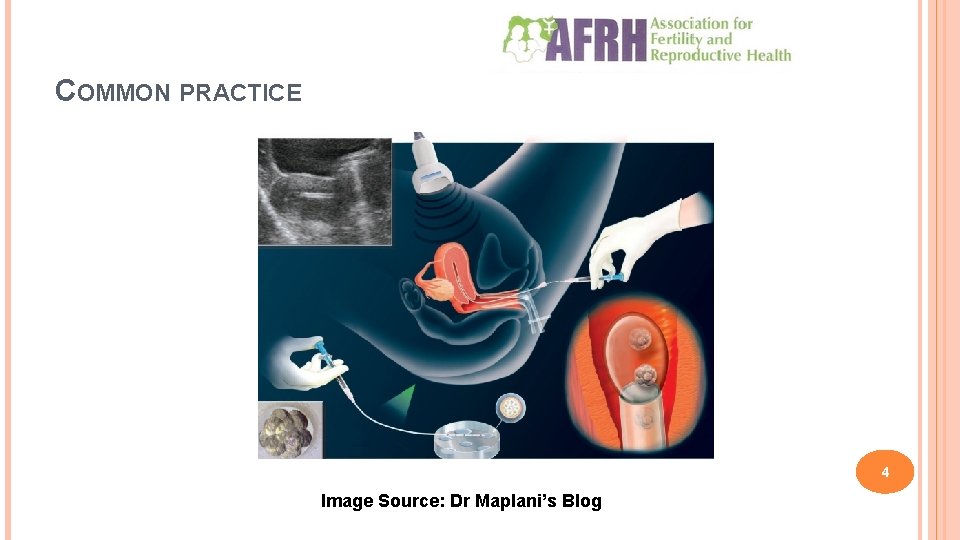 PERFORMING THE EMBRYO TRANSFER A GUIDELINE PRACTICE COMMITTEE