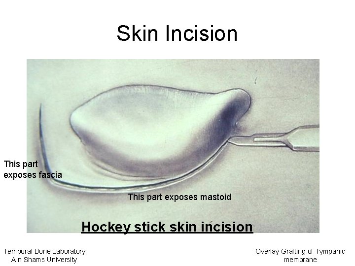 Overlay Grafting Prof Mahmoud El Samaa Prof of