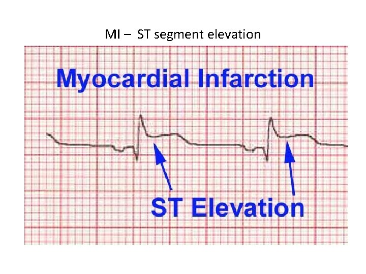 Cardiac enzymes 2 Non enzyme proteins The Troponins