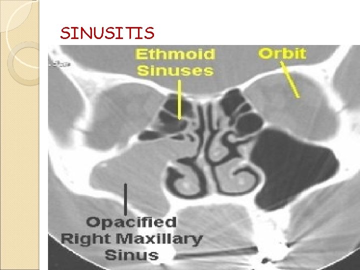 RESPIRATORY INFECTIONS1 UPPER RESPIRATORY INFECTIONS Prof Dr Reha