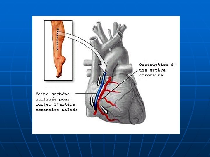 TECHNIQUES DE CHIRURGIE CARDIOVASCULAIRES n n PONTAGE CORONARIEN