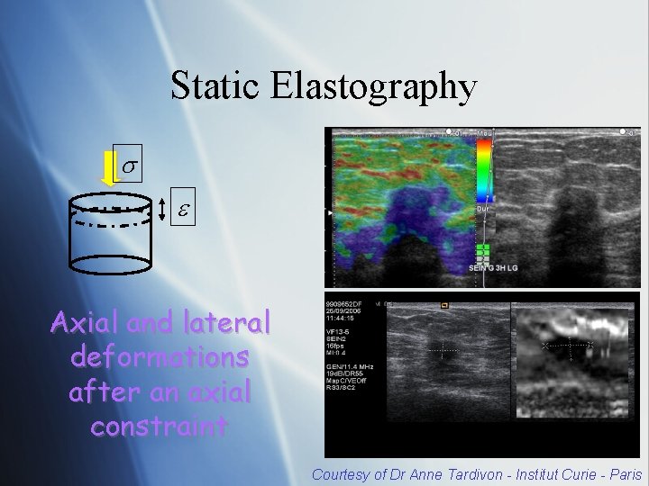 A new Ultrasound modality US Elastography Joel Chabriais