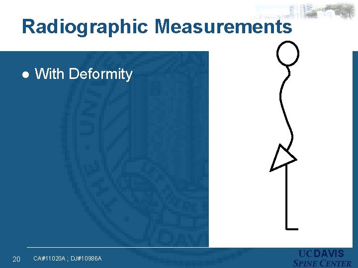 Adult Spinal Deformity Planning Your Osteotomy Surgical Management