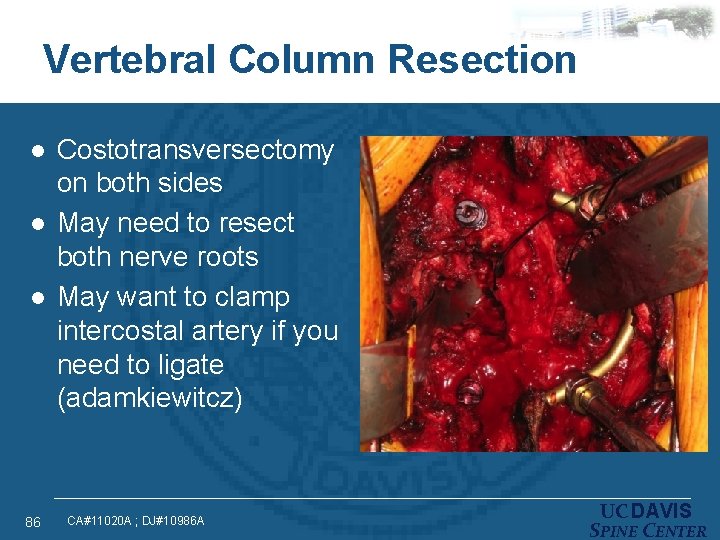 Adult Spinal Deformity Planning Your Osteotomy Surgical Management