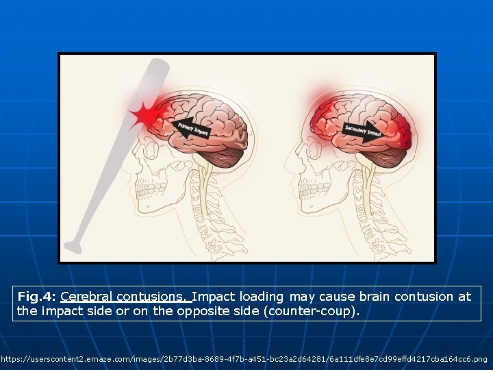 Revisited imaging findings and pathophysiology of abusive head