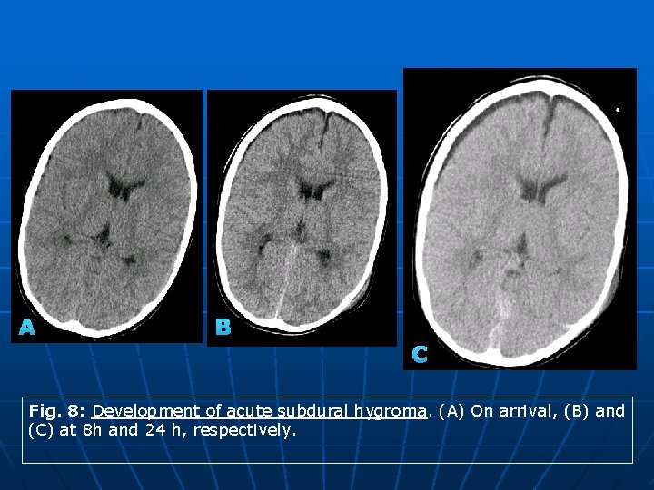 Revisited imaging findings and pathophysiology of abusive head
